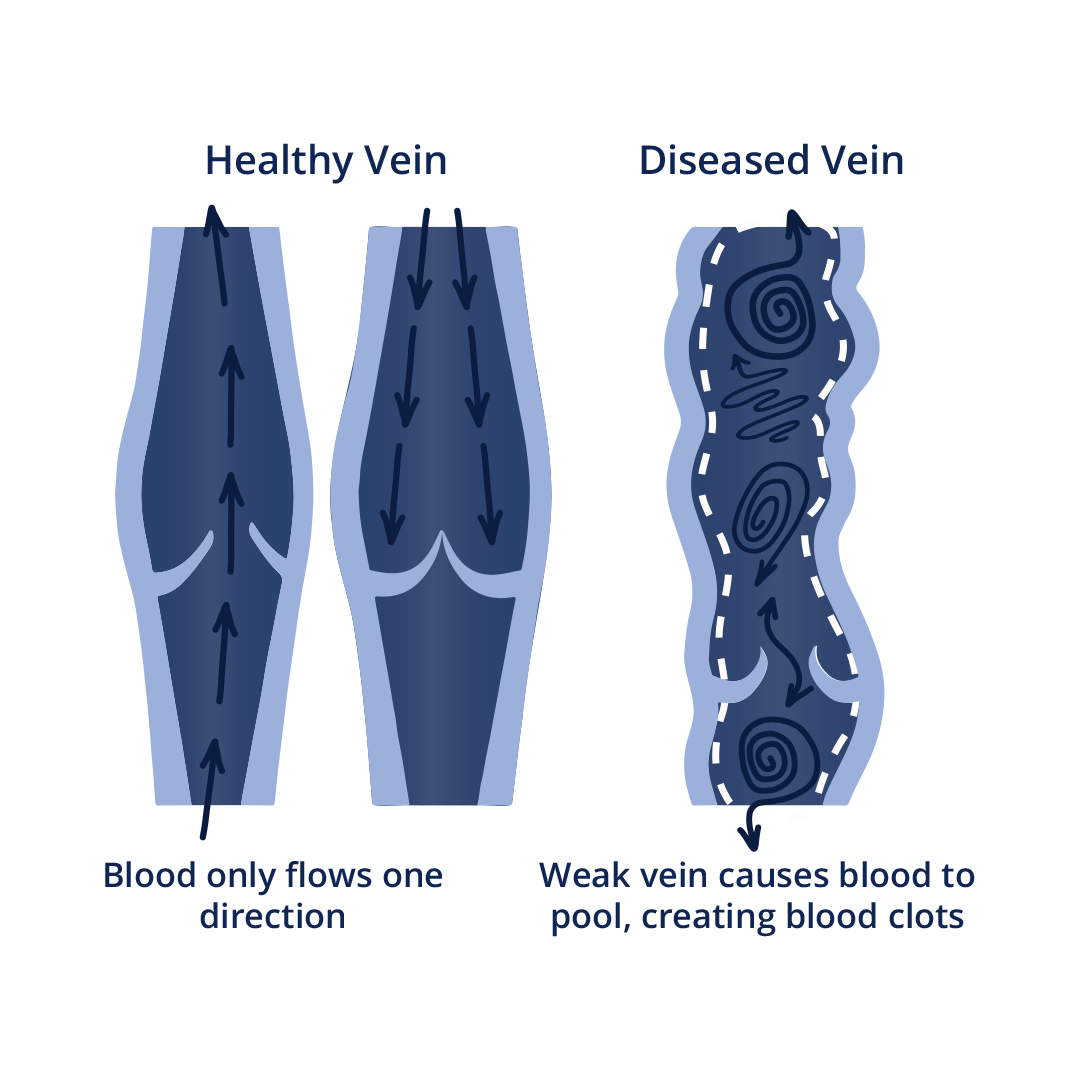 May-Thurner Syndrome Iliac Vein Compression Syndrome - Texas Cardiac ...